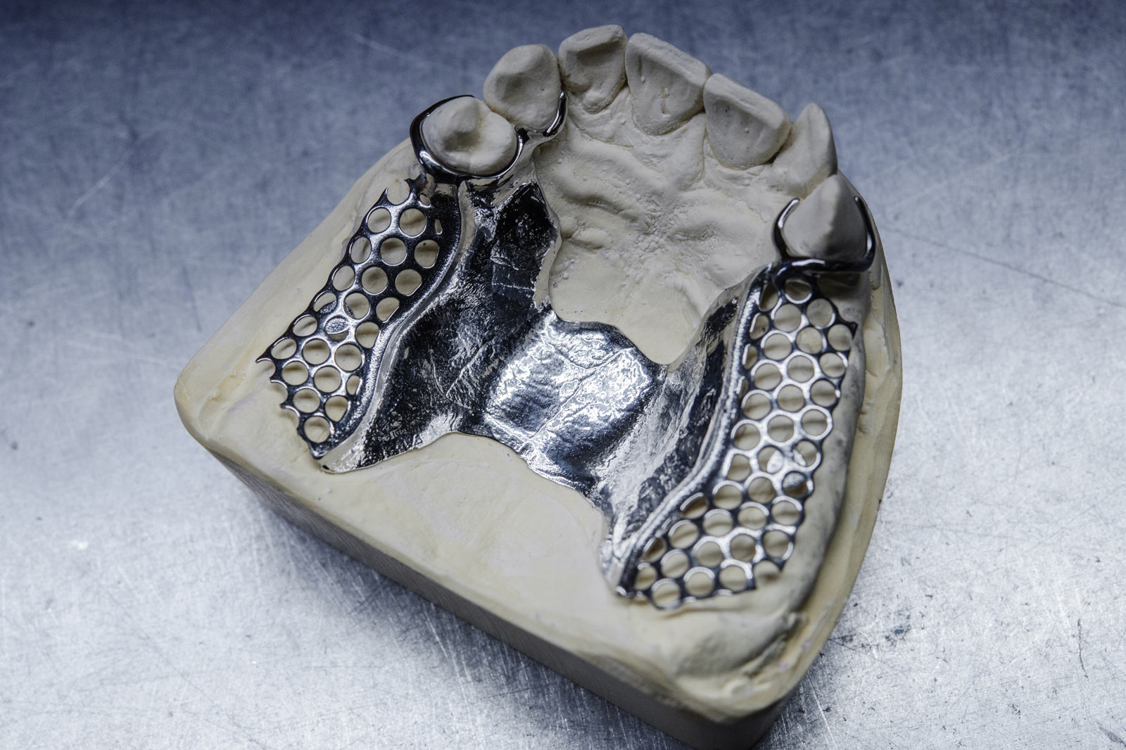 Prothèses adjointes : châssis métallique, résine, gouttière de bruxisme